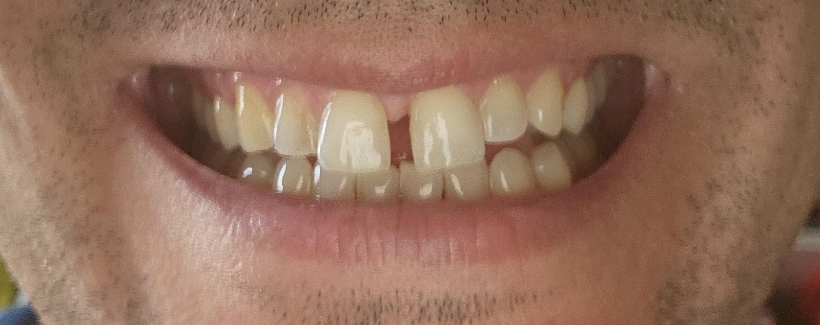 Separación de dientes. Diastema - Tu Web de Ayuda Dental